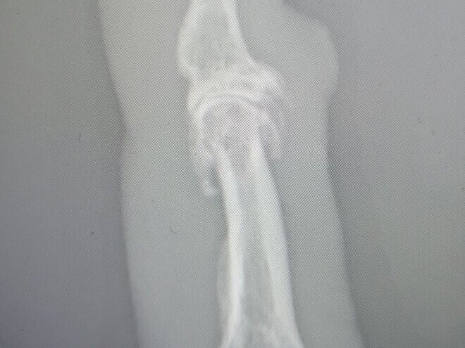 What Is a Digital Mucous Cyst? What That Bump Near Your Fingernail ...